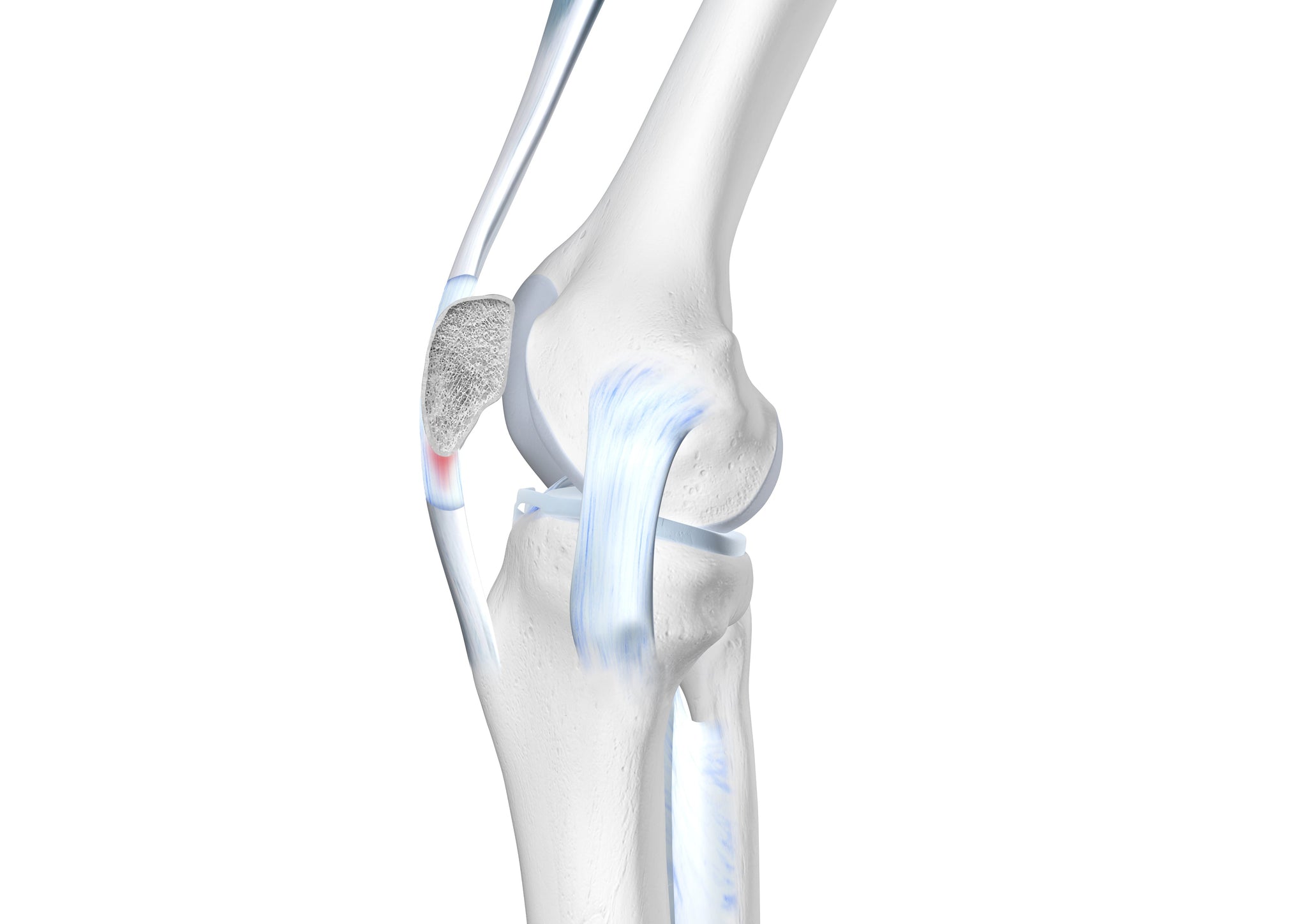 Springerknæ (Jumpers knee)