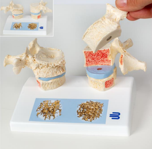 Bauerfeind Anatomisk model - Osteoporose